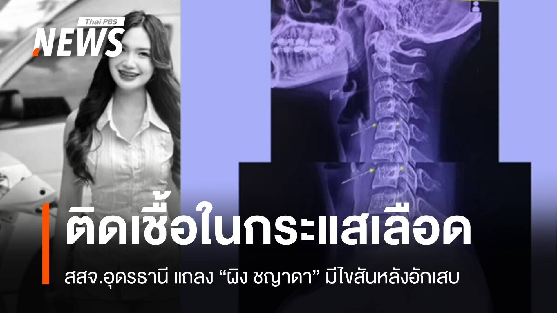 หมอแถลง ผิง ชญาดา ไขสันหลังอักเสบ ติดเชื้อกระแสเลือดตาย Thai Pbs