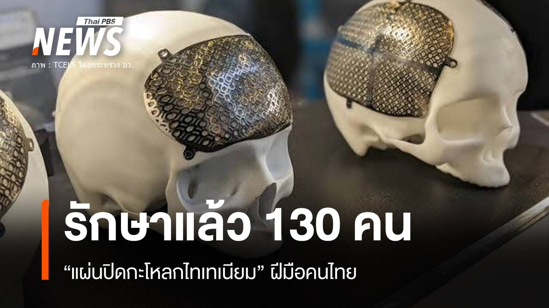 คนไข้ สปสช. 130 คนใช้แผ่นปิดกะโหลกไทเทเนียมฝีมือคนไทย | Thai PBS News ข่าวไทยพีบีเอส