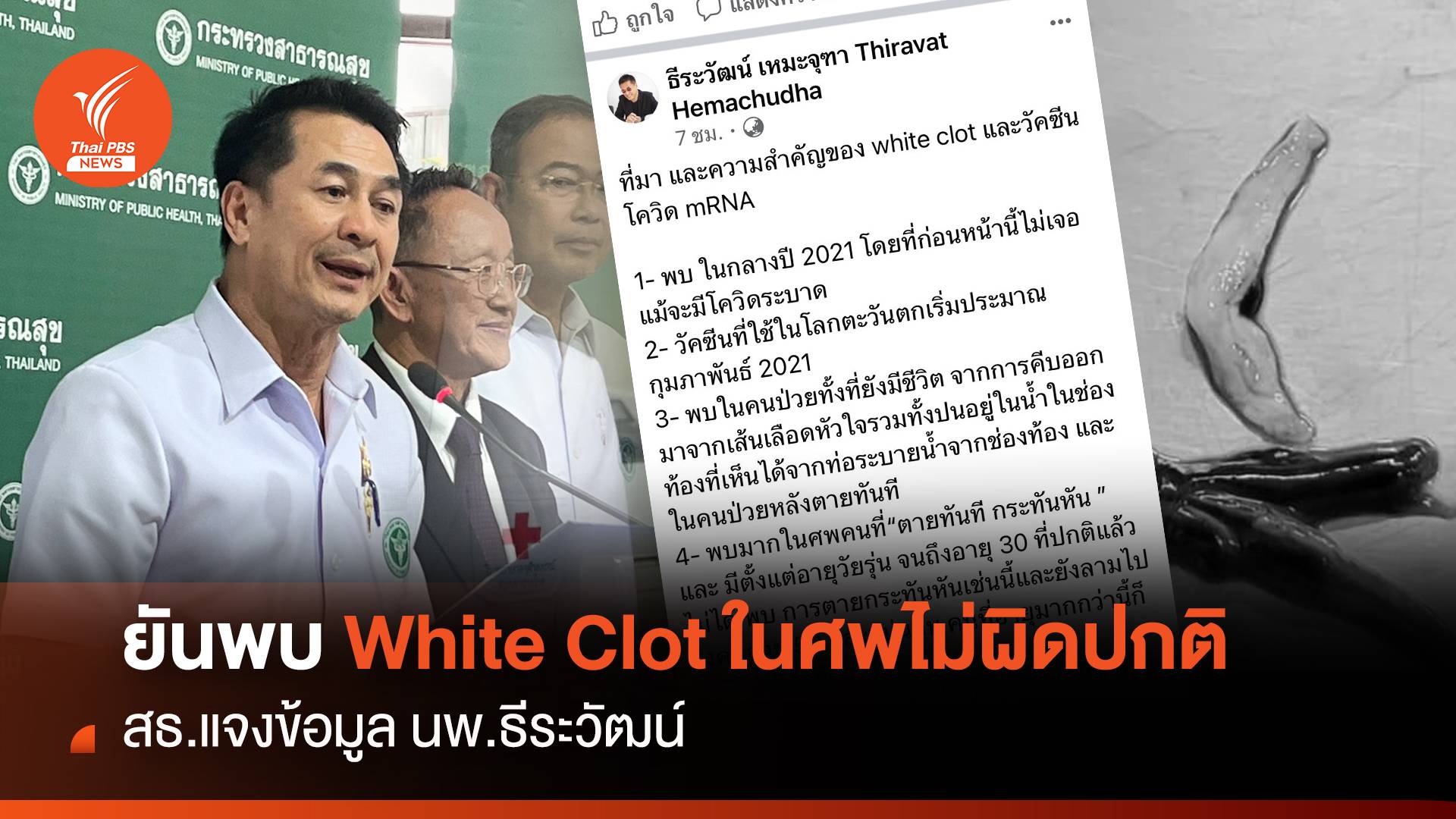 สธ.แจงข้อมูล นพ.ธีระวัฒน์ ยันพบ White Clot ในศพไม่ผิดปกติ | Thai PBS ...